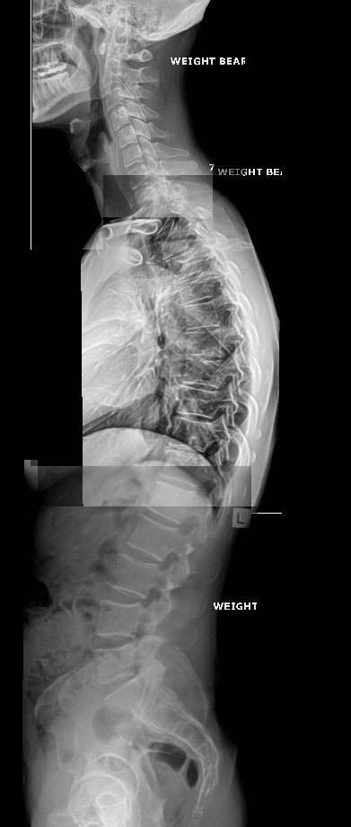 Full spine spinal x-rays - OptiStart Chiropractic