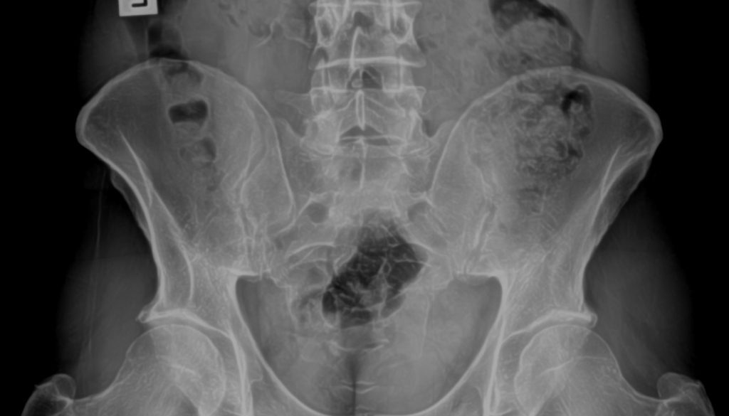 Normal Pelvis X Ray