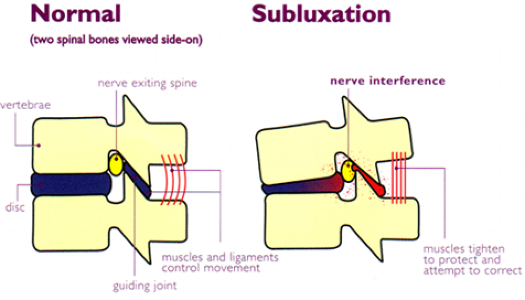 Subluxation: An interference to the nerve system - OptiStart Chiropractic